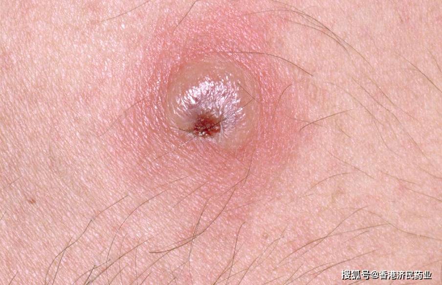 皮肤T细胞淋巴瘤IL-2受体靶向免疫疗法Lymphir在美获批_患者_Citius_治疗