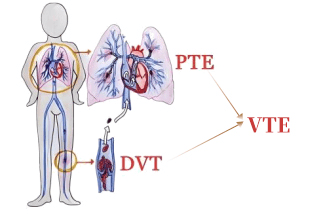 齐佳医疗带你了解VTE和DVT，PE和PTE的区别_栓塞_血栓_肺动脉