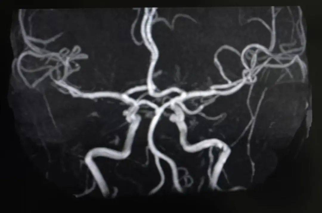【健康医声】CTA、MRA、DSA分不清楚， 一文带你搞懂三种关于"A”的检查_血管_成像_优缺点